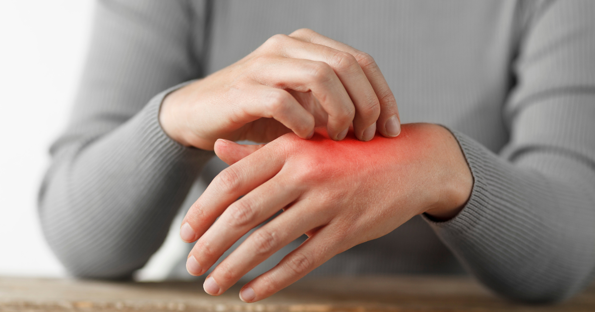 Itchy Skin after Burn Injury